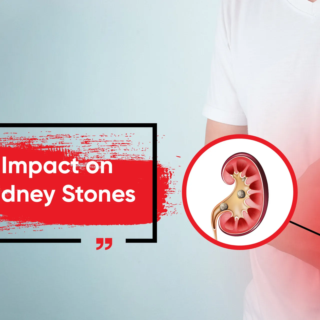 What is The Impact Of Hydration in Preventing Kidney Stones