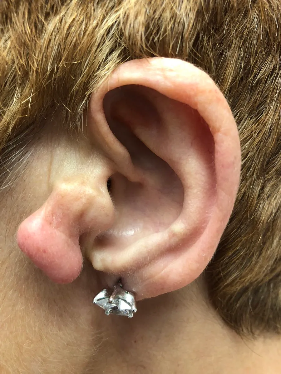 Apéndice Preauricular, ¿Problema Grave o Estético? | Preauricular A...