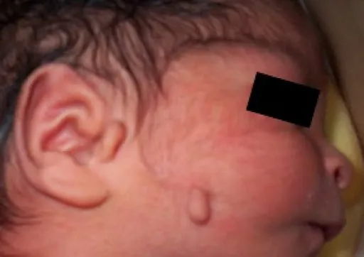 Apéndice Preauricular, ¿Problema Grave o Estético? | Preauricular A...