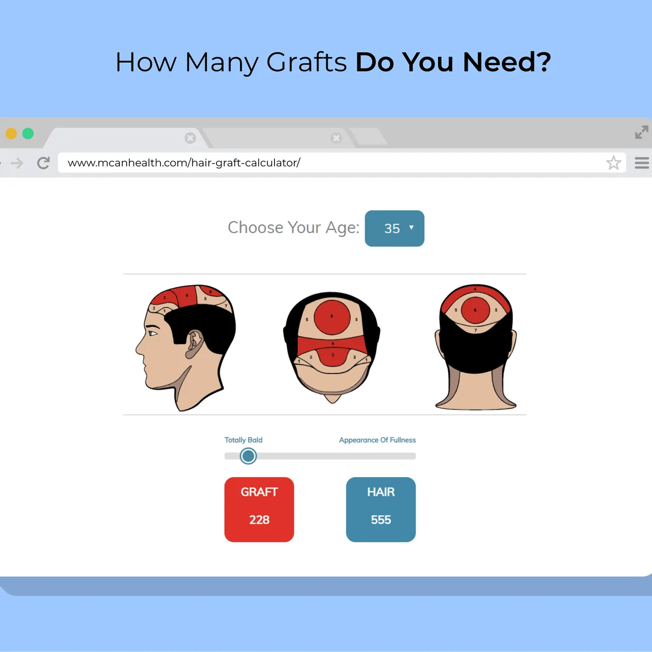 Graft Calculator - Calculate grafts and hairs you need in 3 steps
