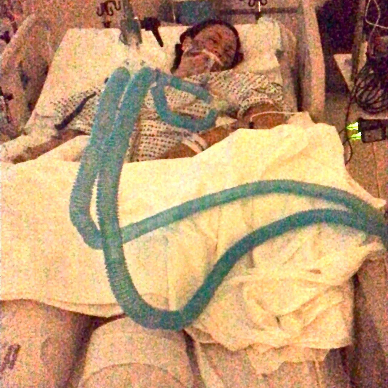 Pseudo Coma; A Case of Locked In Syndrome