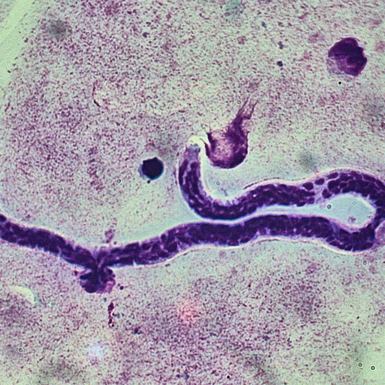 All you need to know about Loa loa the African worm parasite.