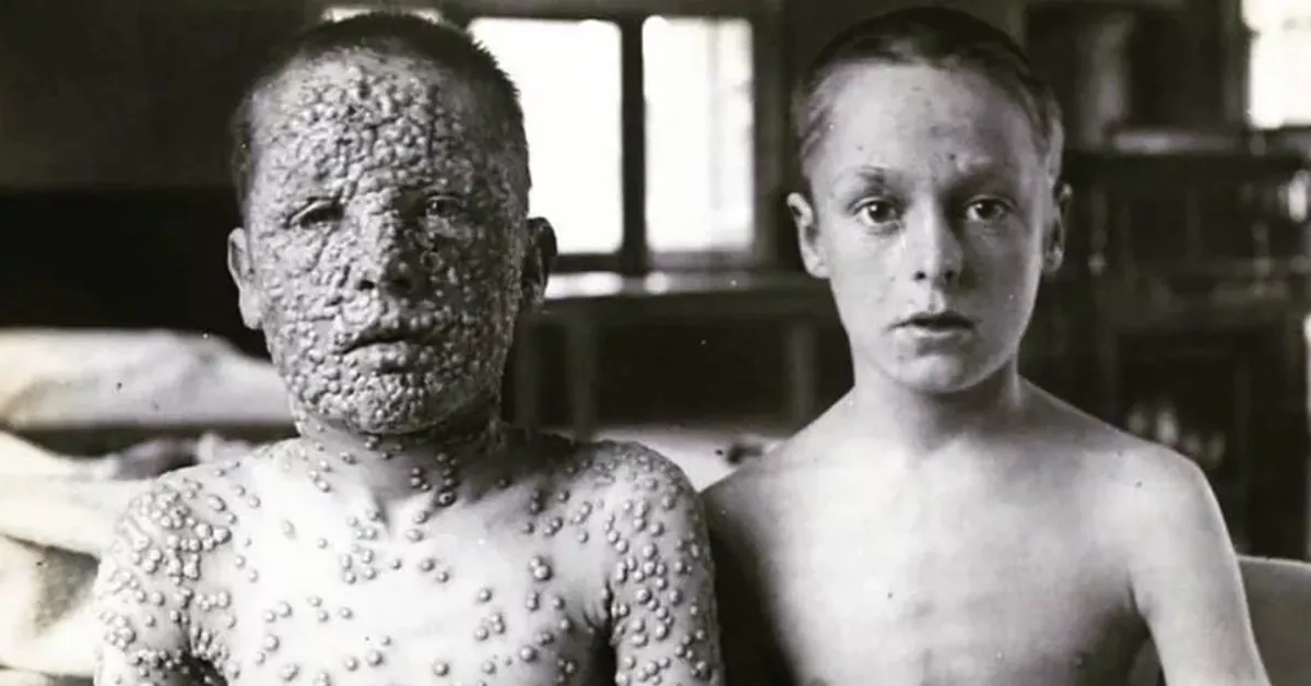 Fun Facts About Smallpox: Mummies, Human Trafficking, and Benjamin ...