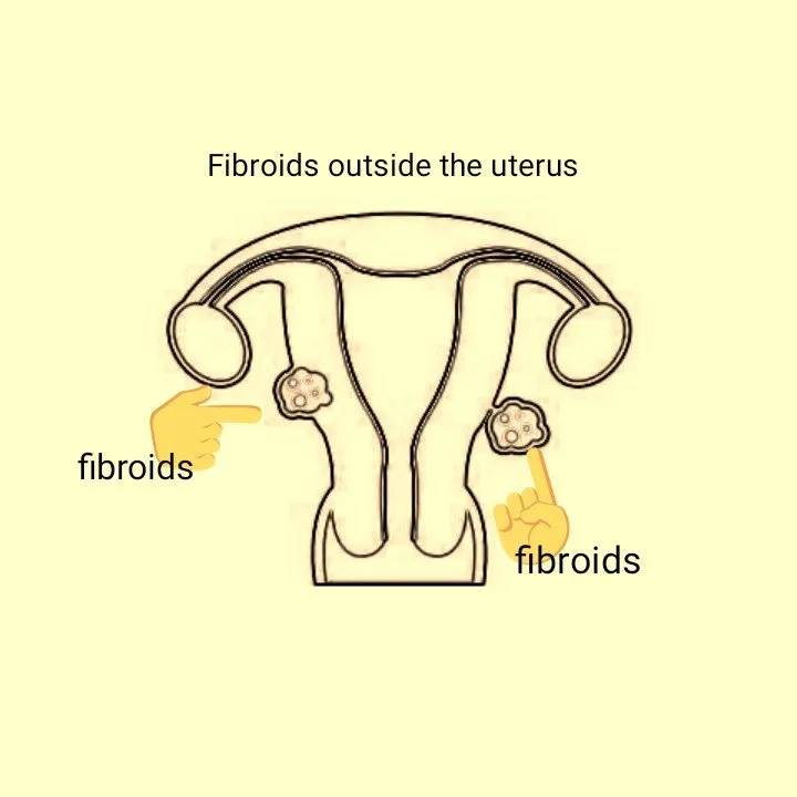 Facts about fibroids.