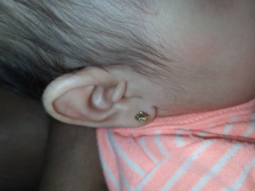 Apéndice Preauricular, ¿Problema Grave o Estético? | Preauricular A...