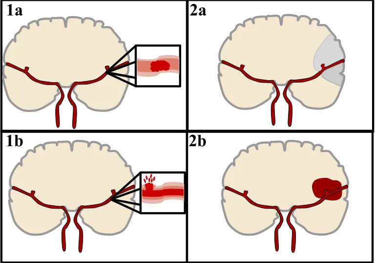 Neuro Pathophysiology - Stroke Syndromes