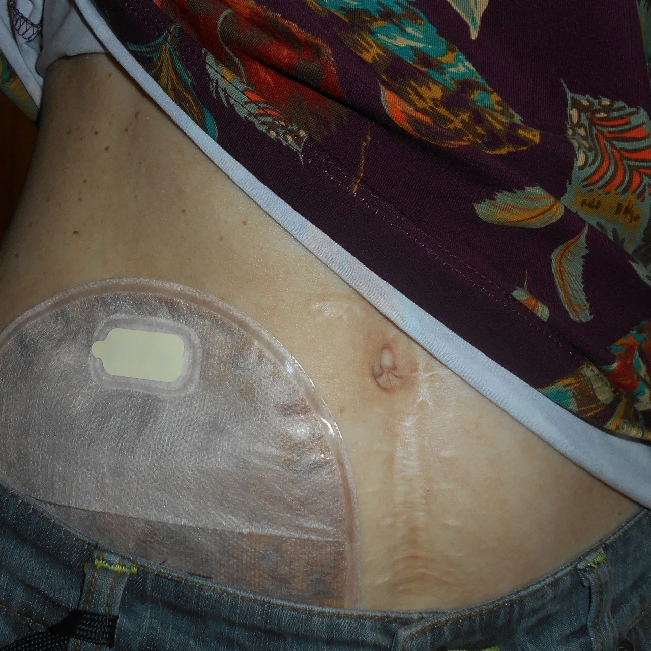 Ostomy; The Artificial Opening of the Bowel