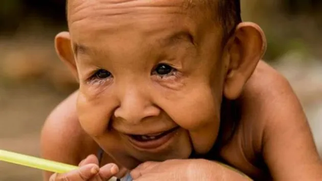 The Real Benjamin Button! Meet the four-year baby seems 80
