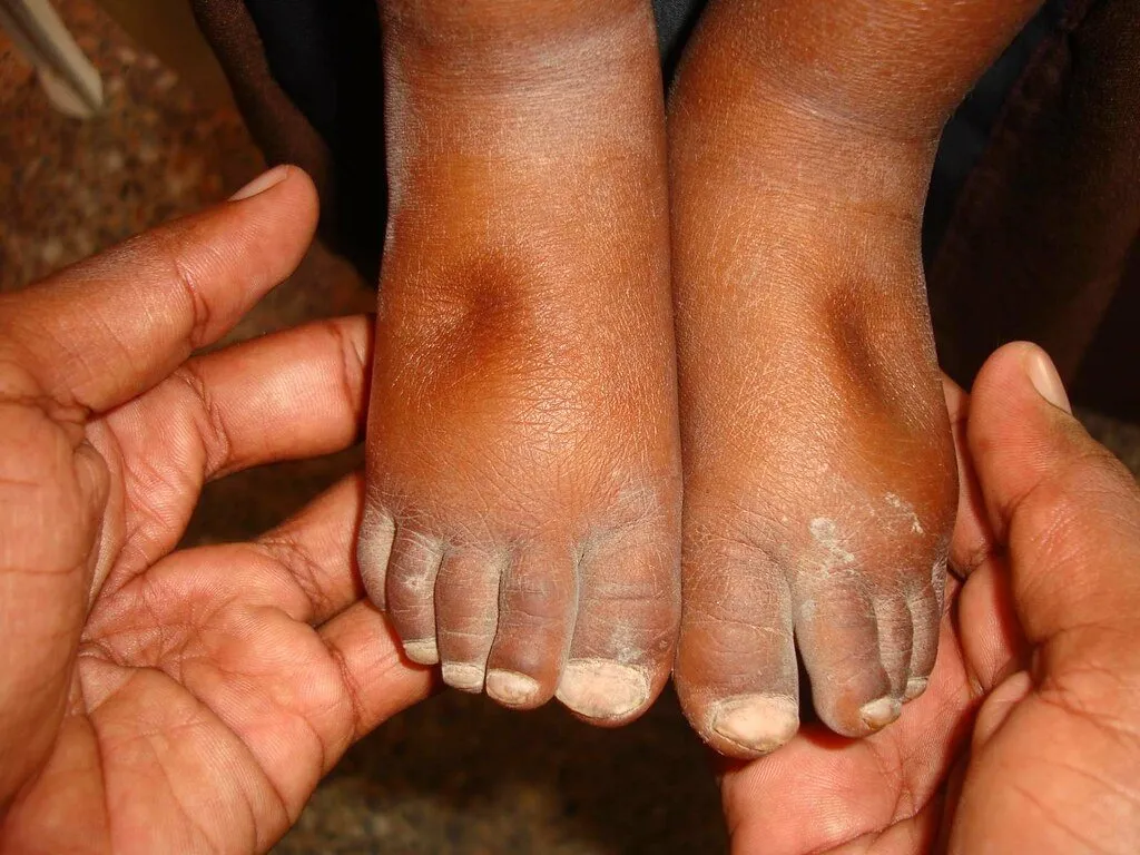 Physiology, Symptoms, Diagnosis, and Treatment of Peripheral Edema