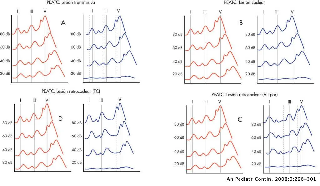Apéndice Preauricular, ¿Problema Grave o Estético? | Preauricular A...