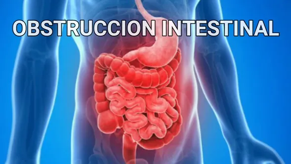 Trastornos de las Vías Gastrointestinales: Obstrucción Intestinal.