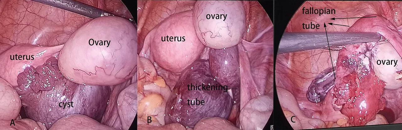 Cyst in the Ovary and PCOS
