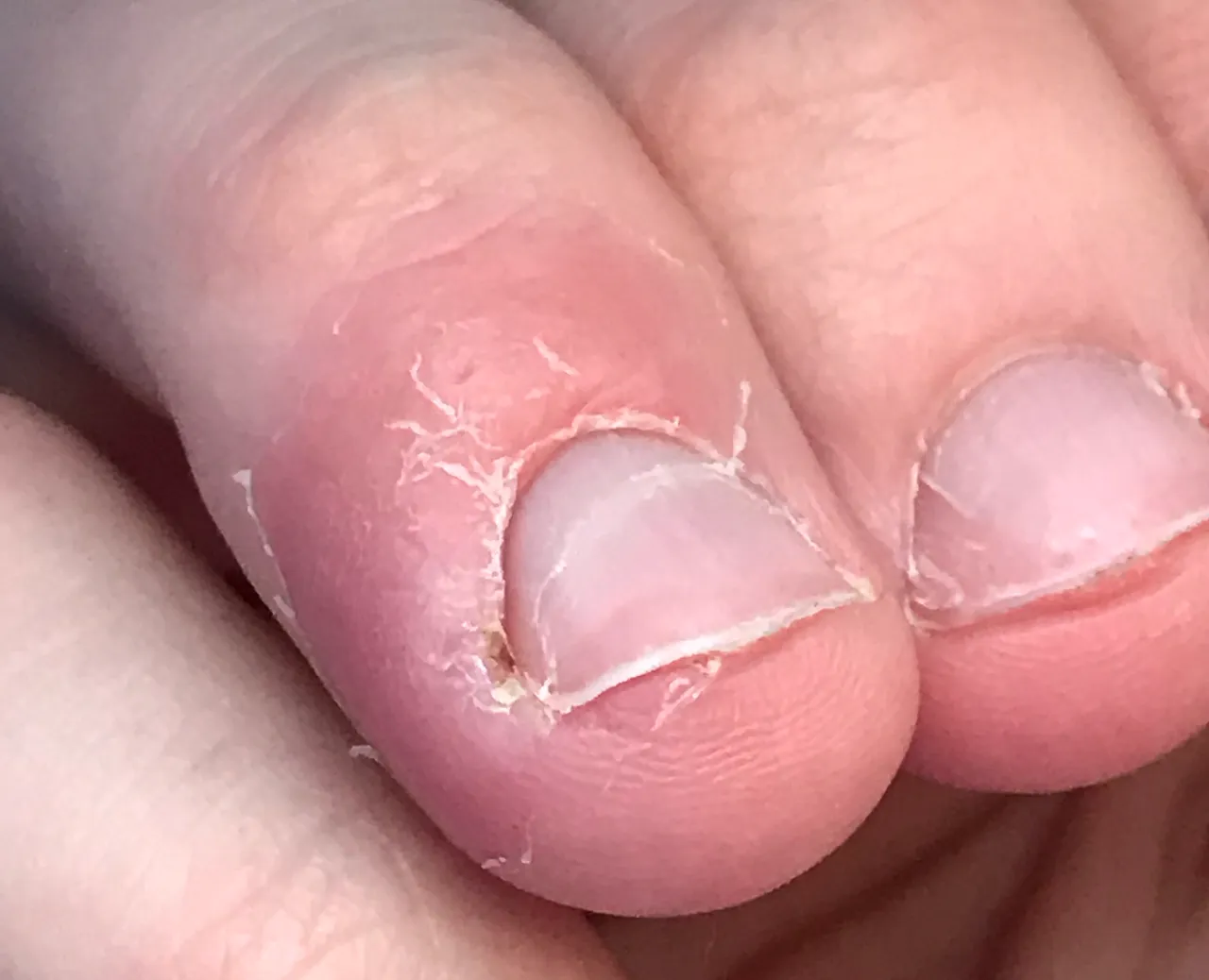 Paronychia Infection, a Serious Type of Nail Infection.