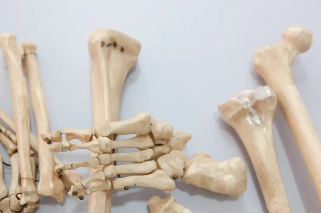 Thick Bones But Guess What? They Are Fragile! (Osteopetrosis with u...