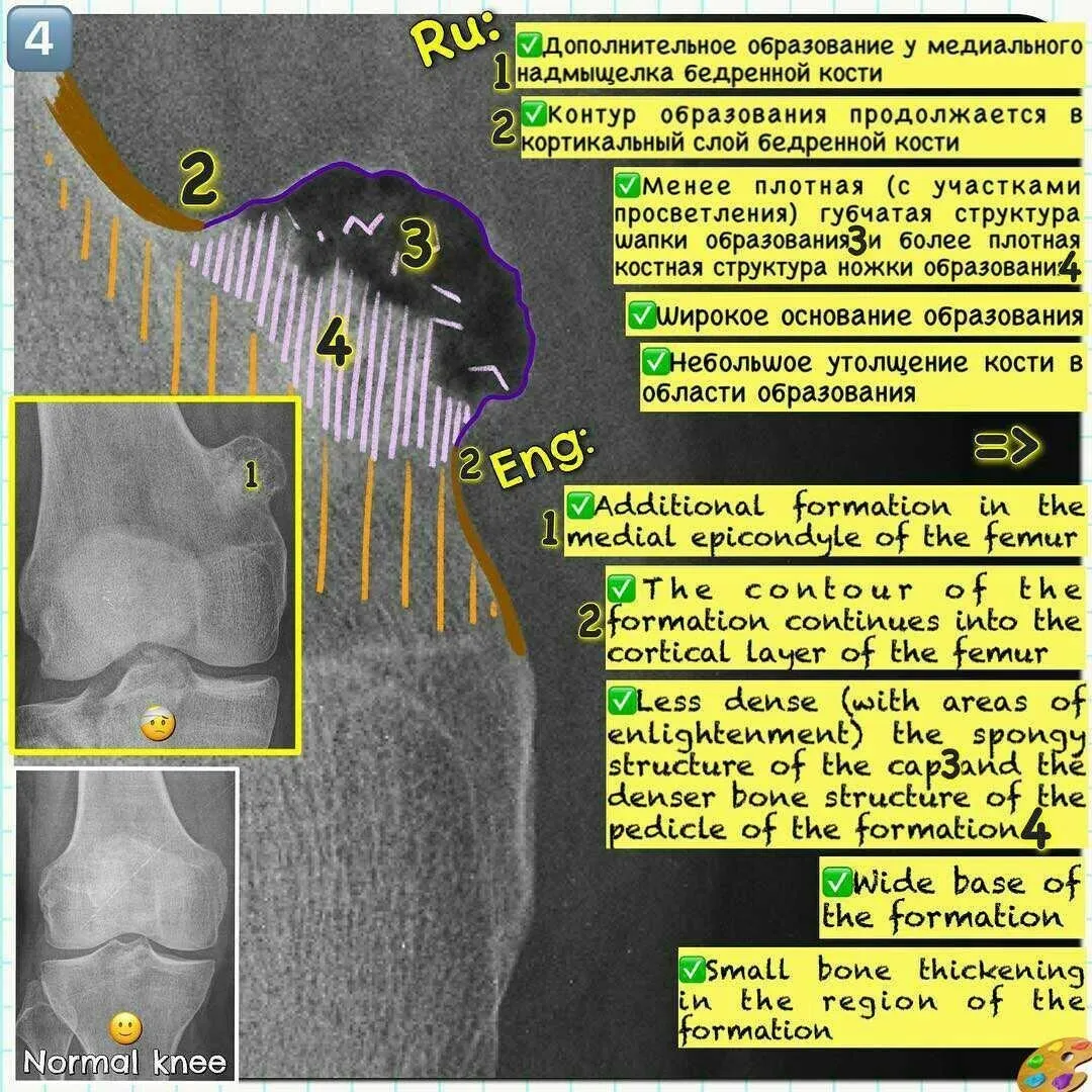 Radiology And Anatomy Of The Knee Joint (Patella).